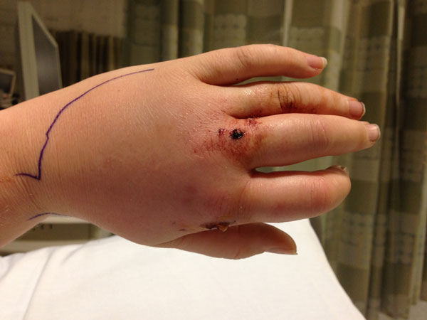 What I Learned from Being Badly Bitten by a Dog During a Rescue – Dogster